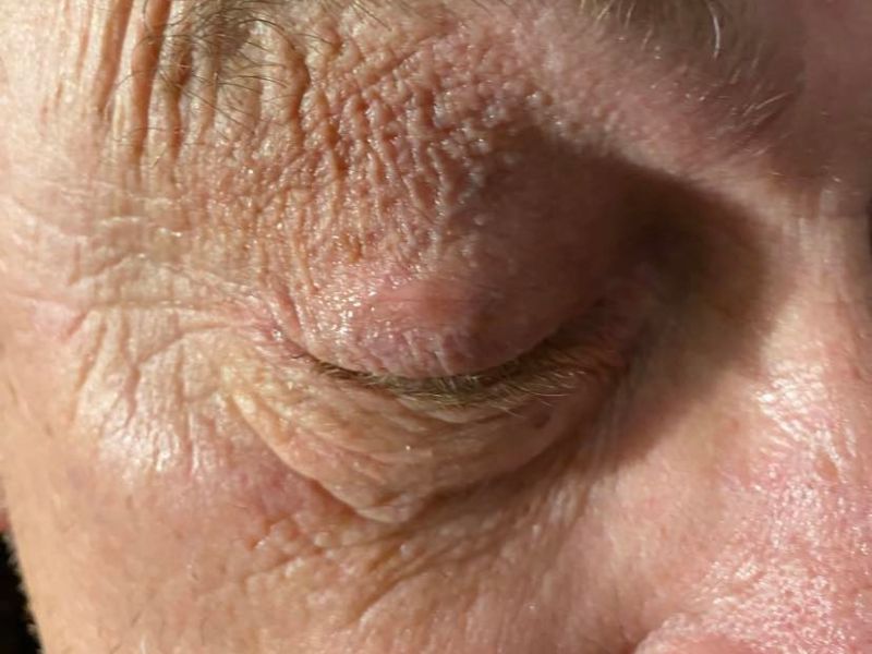 Skin Tag Removal - Pure Hair Beauty & Aesthetics